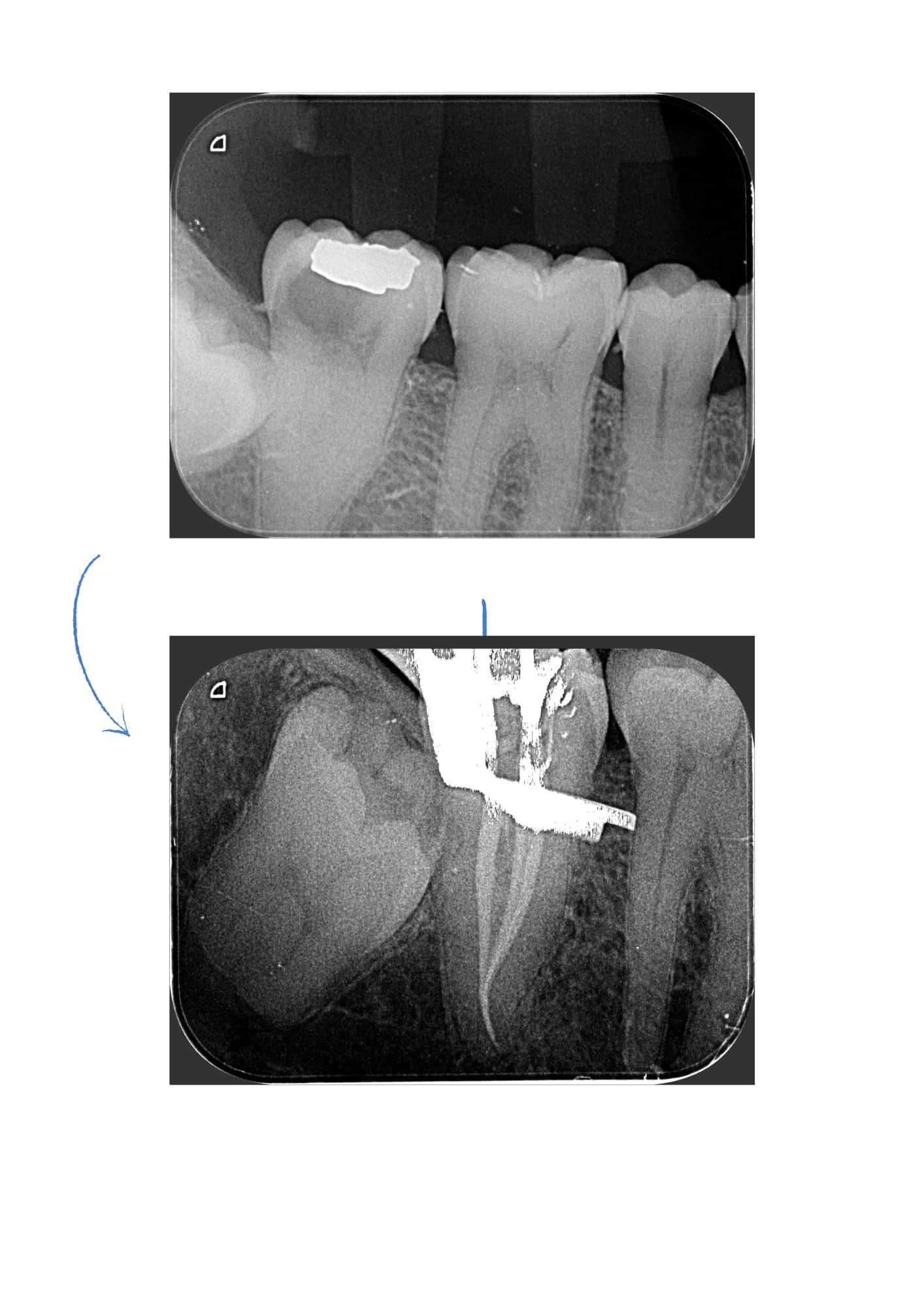 Caso clínico | Endodoncia con miscroscopio